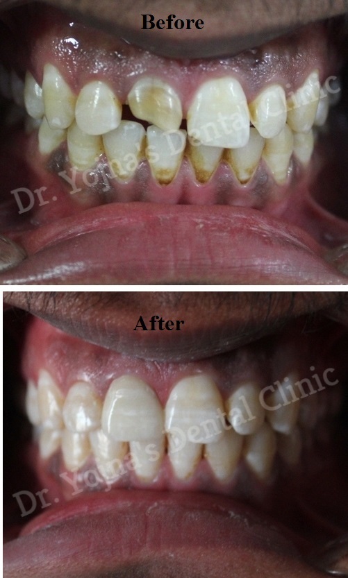 Dr Yojna's Dental Clinic » Lava E-Max Crown For Chipped Tooth