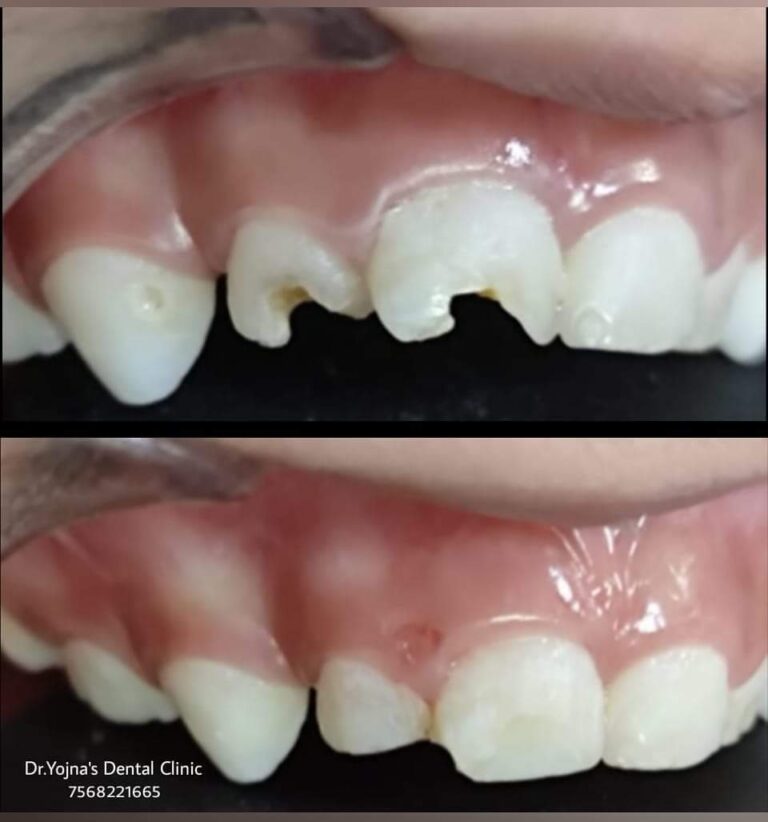 Dr Yojna's Dental Clinic » GIC Filling For Children’s Teeth